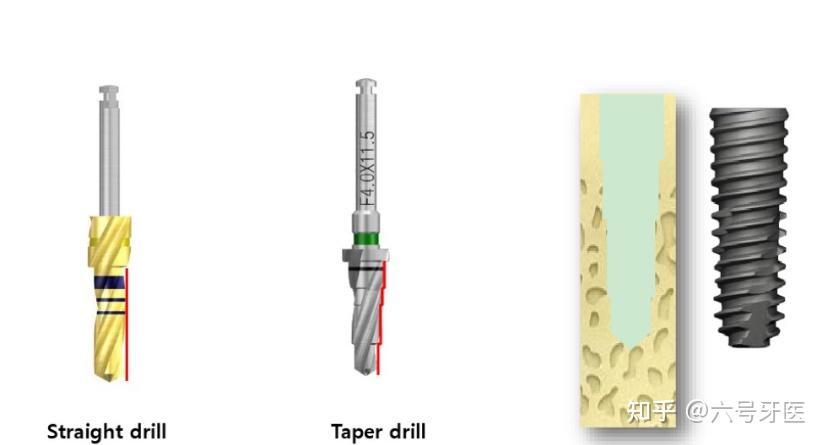 奥齿泰Taper Kit种植牙工具盒图解 - 知乎