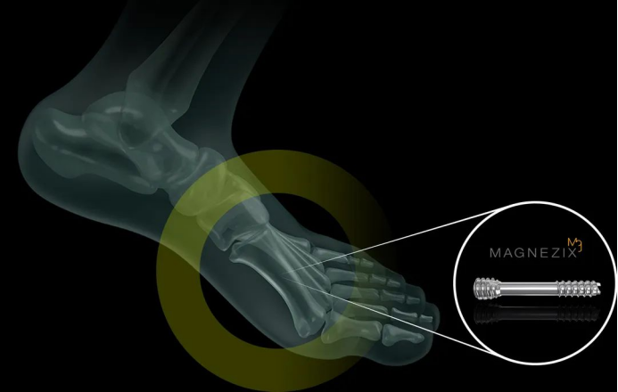 “镁”力无限—揭秘可降解镁材料的医疗魅力 - 知乎