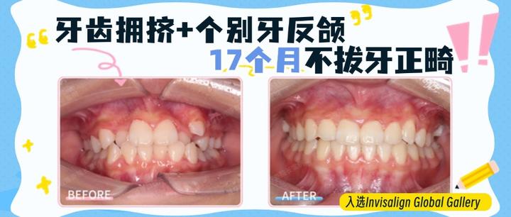 入选Invisalign Global Gallery | 牙齿拥挤+个别牙反颌，不拔牙矫正，17个月获完美笑容及健康咬合 - 知乎