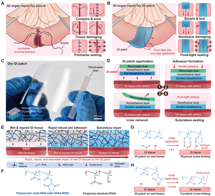 MIT赵选贺Science子刊：有望替代胃肠手术缝合线的组织粘合贴片 - 知乎
