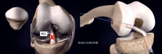 布骨告诉你，ACL重建术后康复最全面、最详细方案（前期） - 知乎