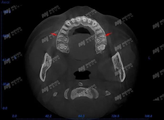 美亚口腔CBCT，让MB2无所遁形！ - 知乎
