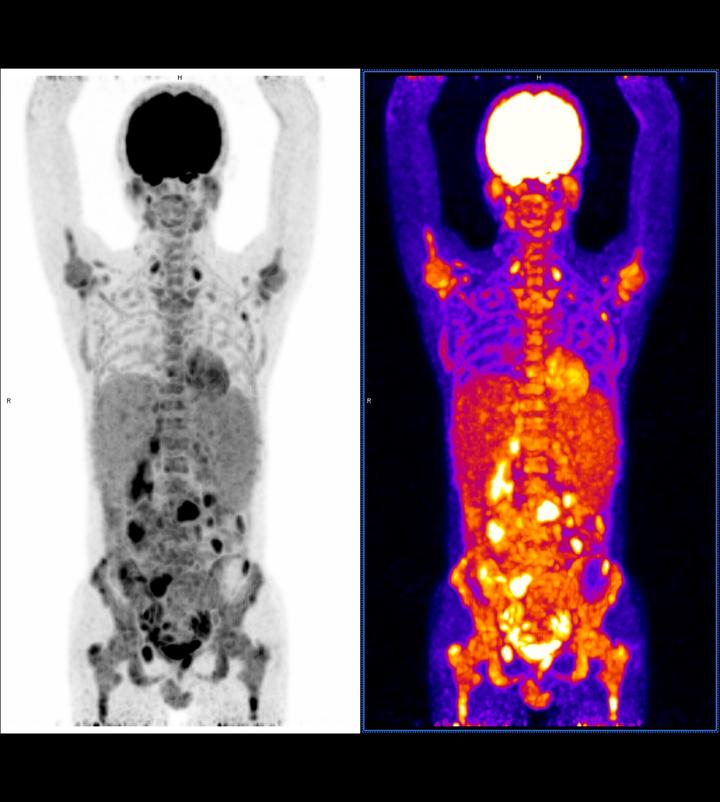 淋巴瘤难治？PET/CT检查可帮助治疗 - 知乎