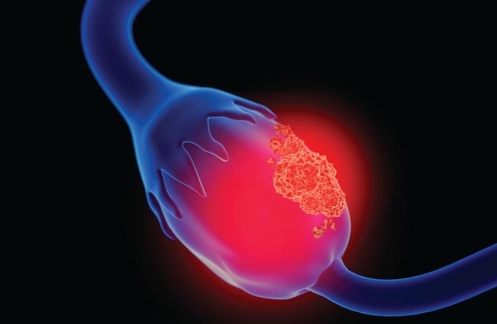 FDA批准CYTALUX(pafolacianine)，用于在手术期间识别卵巢癌 - 知乎