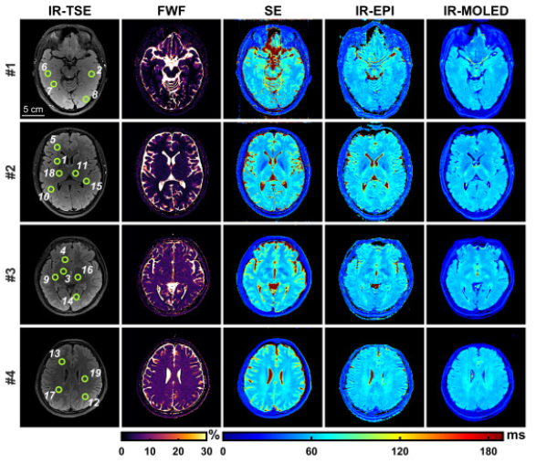 术前FLA-T2 mapping结合IR-MOLED成像，可预测脑膜瘤的分级和分型 - 知乎