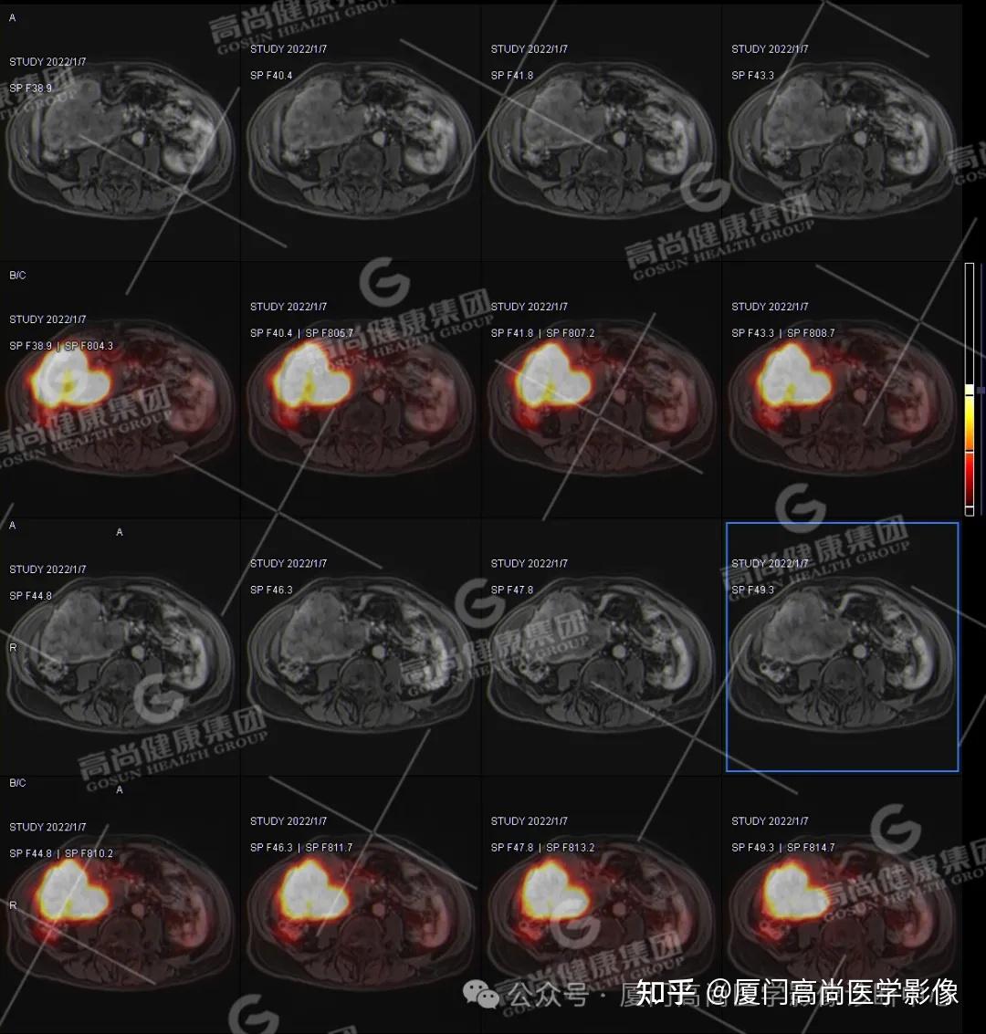 【高尚病例】PET/CT-MR 多模态融合技术在临床中的应用病例分享（一） - 知乎