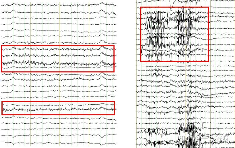 EEG常见伪迹类型 - 知乎