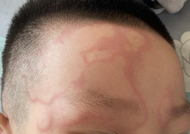 一运动就过敏，原来和这些食物有关！ - 知乎