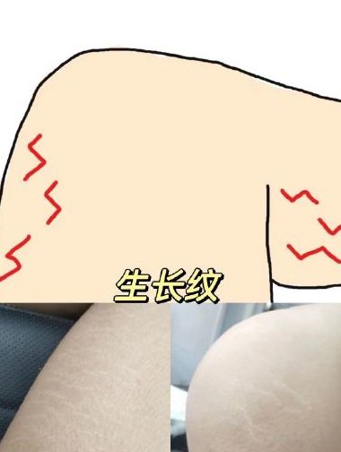 长了生长纹不要害怕,可以这样淡化它 知乎