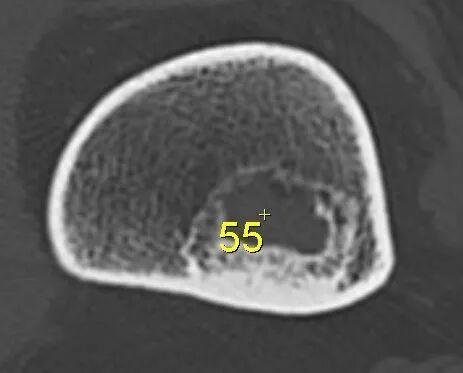 非骨化性纤维瘤（Nonossifying Fibroma, NOF）诊断要点 - 知乎