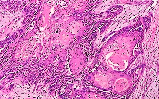 J Clin Pathol | 复发或转移性头颈部鳞状细胞癌中PD-L1表达的多中心回顾性研究 - 知乎
