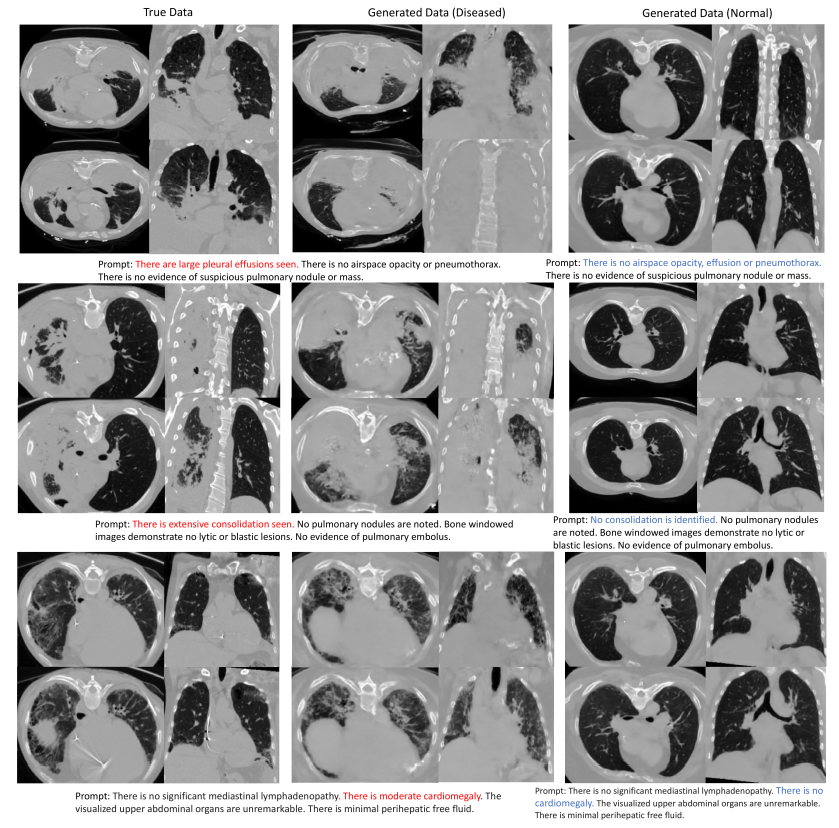 医学生成模型MedSyn：文字引导，AI“画”出高保真CT图像 - 知乎